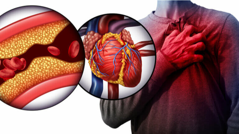 What Is A Blood Clot: Causes, Symptoms, And Treatment