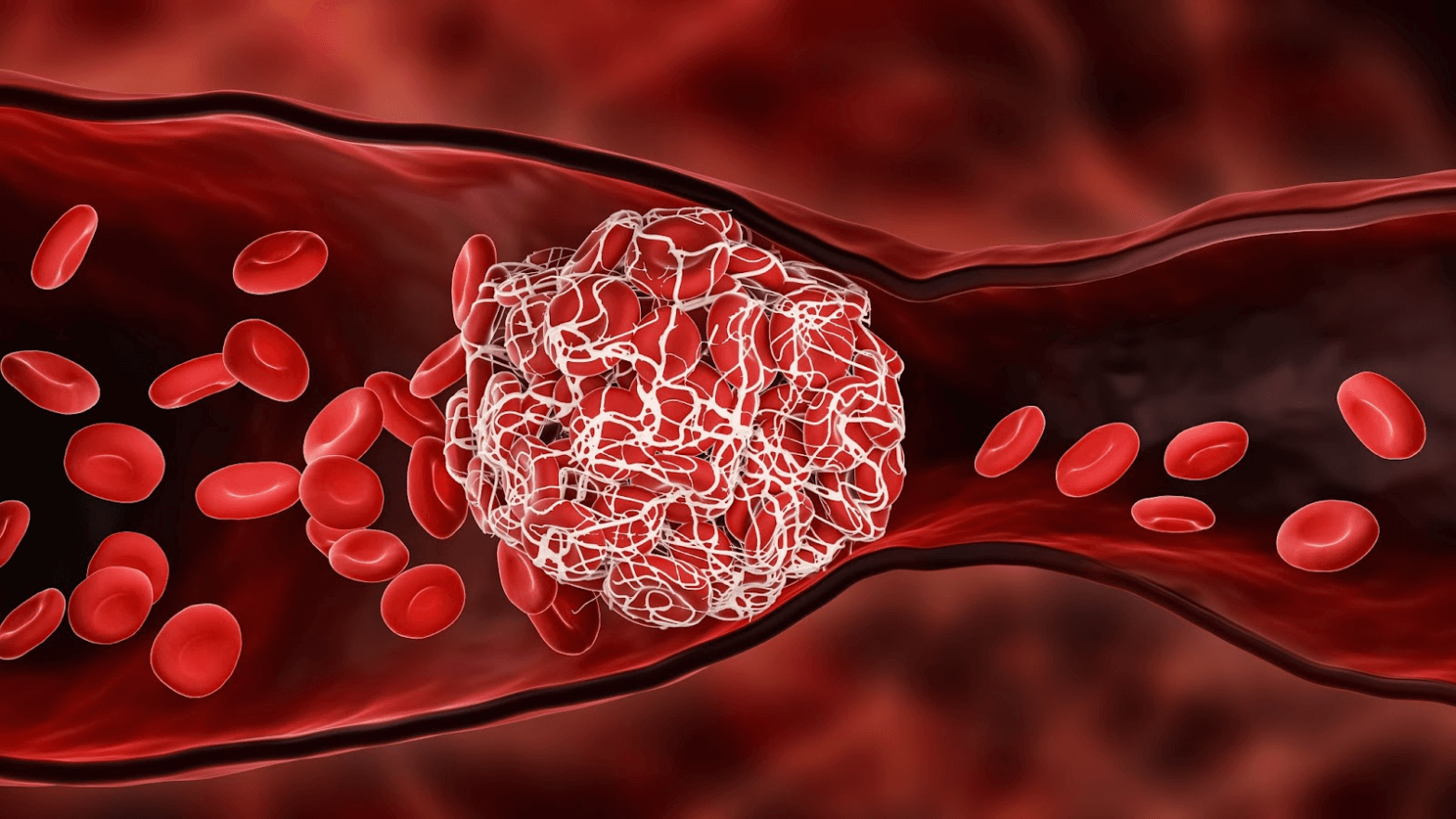 Are Blood Clots Life-Threatening?