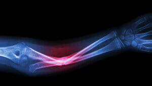 Untreated Broken Bone: Risks