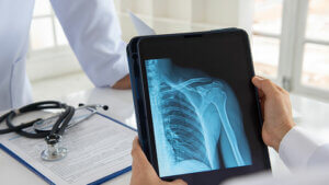 Untreated Broken Bone: Risks